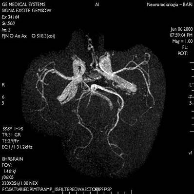 Severe Anisocoria after Oral Surgery under General Anesthesia