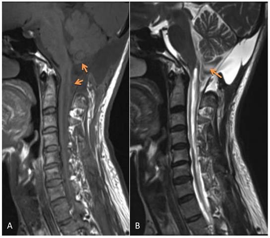 Foramen Magnum Arachnoid Cyst Induces Compression of the Spinal Cord ...