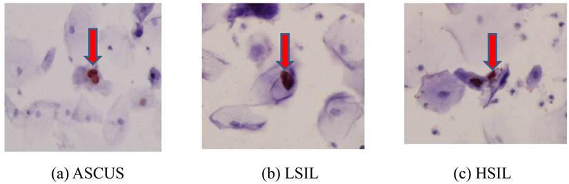 Clinicopathological Implications of Human Papilloma Virus (HPV) L1 ...