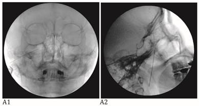 Trigeminal nerve block with alcohol for medically intractable classic ...