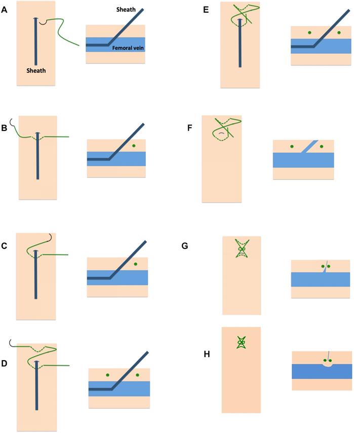 Feasibility of the Figure-of-8-Suture as Venous Closure in ...
