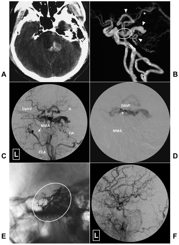 Endovascular treatment for dural arteriovenous fistulas in the ...