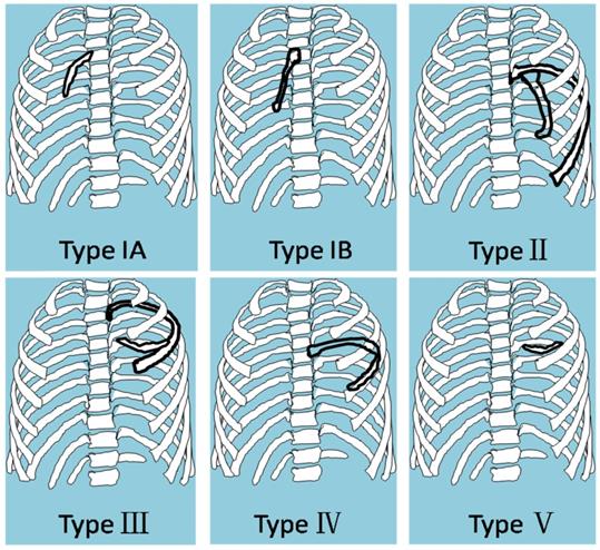 Intrathoracic rib: rare rib anomaly, review of the literature and ...