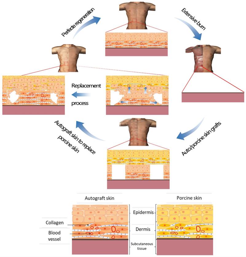 In situ scarless skin healing of a severe human burn wound induced by a ...