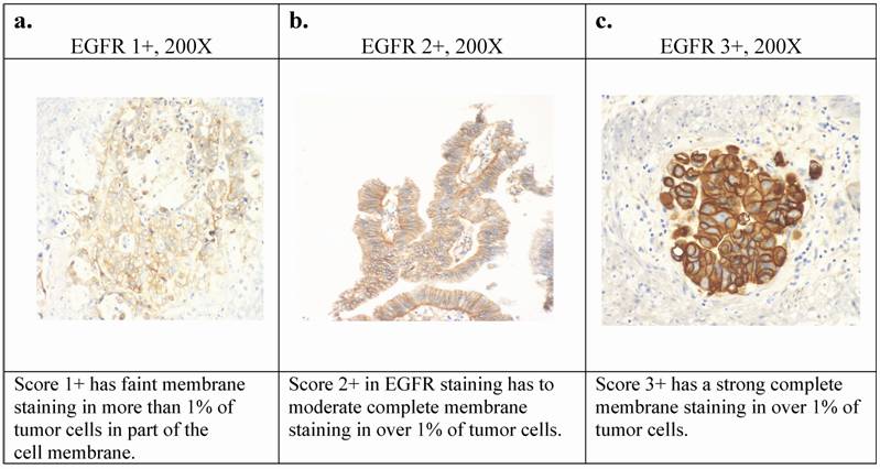 EGFR Expression in Gallbladder Carcinoma in North America