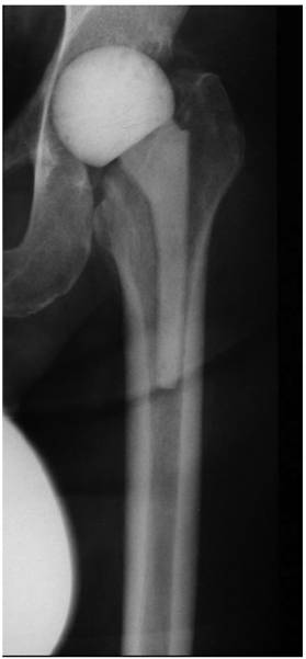 Mechanical complications and reconstruction strategies at the site of ...