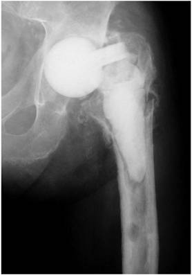 Mechanical complications and reconstruction strategies at the site of ...
