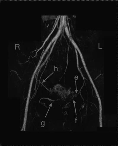 Changes of uterine blood flow after vaginal radical trachelectomy (VRT ...