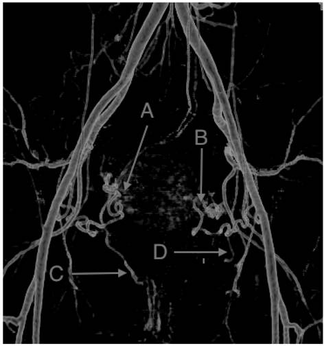 Changes of uterine blood flow after vaginal radical trachelectomy (VRT ...