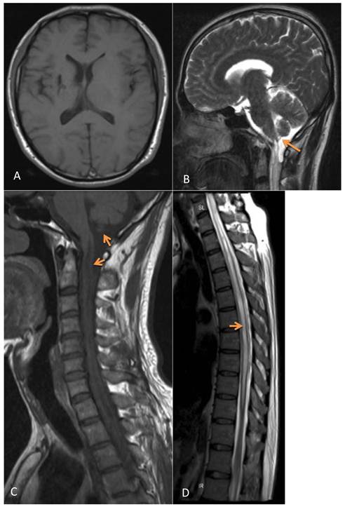 Foramen Magnum Arachnoid Cyst Induces Compression of the Spinal Cord ...