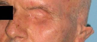 The Versatile Use of Temporoparietal Fascial Flap