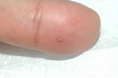 Tender Papule Rising on the Digit: Pacinian Neuroma Should Be ...