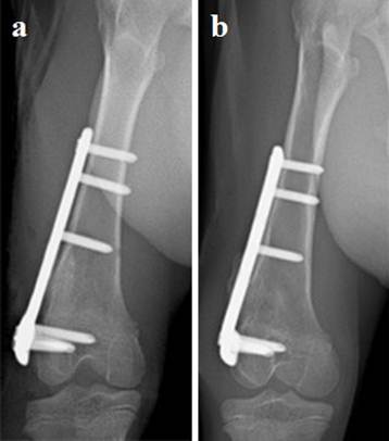 Effects of a Sliding Plate on Morphology of the Epiphyseal Plate in ...