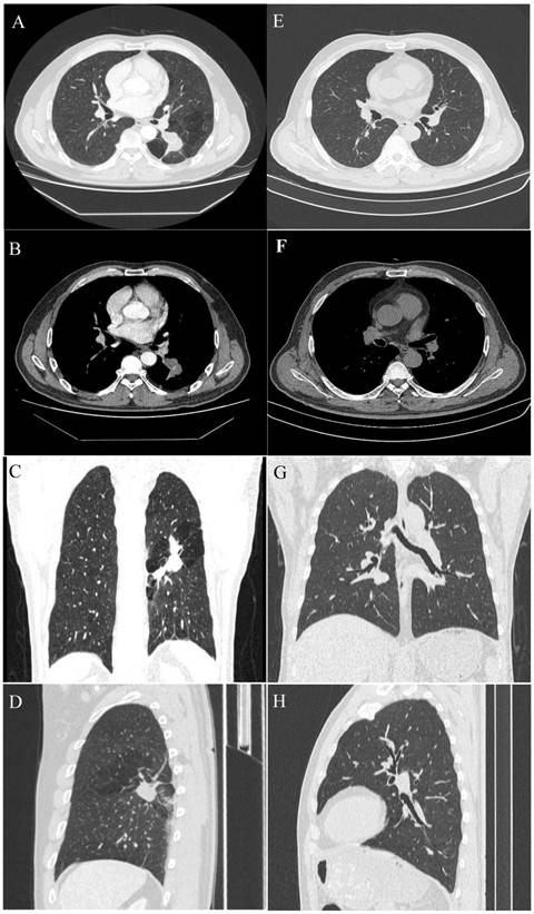 Congenital Bronchial Atresia: Diagnosis and Treatment