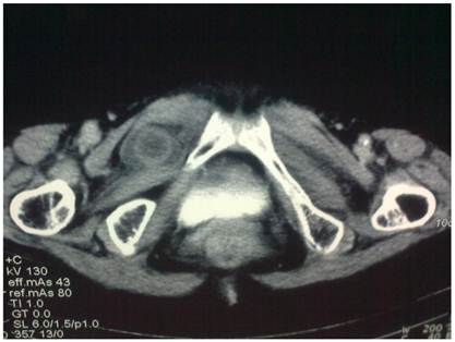 Strangulated Intestinal Obstruction Secondary to a Typical Obturator ...