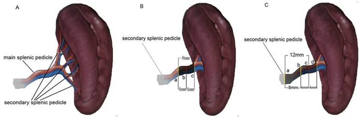 A Two-Step Control of Secondary Splenic Pedicles Using Ligasure during ...