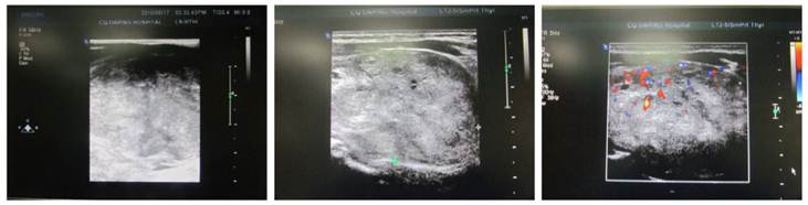 Peri-Operative Treatment of Giant Nodular Goiter