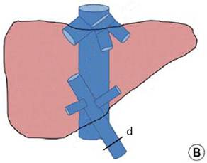 Curative Resection of Hepatocellualr Carcinoma Using Modified ...