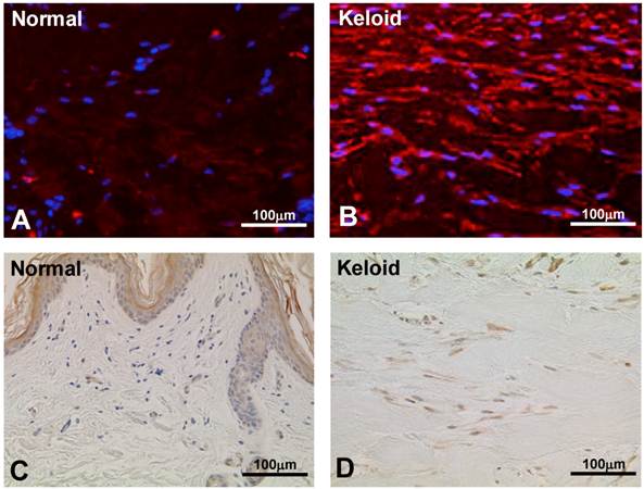 Identification and Characterization of Wnt Signaling Pathway in Keloid ...
