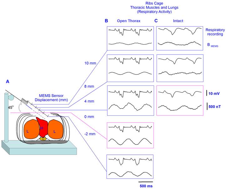 Respiratory Magnetogram Detected with a MEMS Device