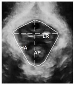 Three-dimensional Ultrasound Appearance of Pelvic Floor in Nulliparous ...
