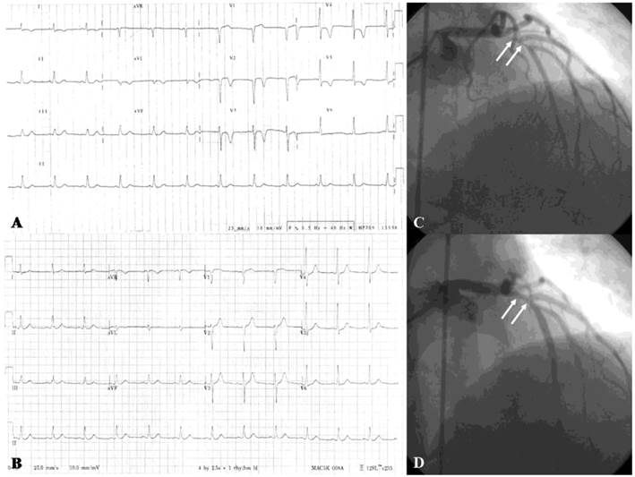 Coronary Artery Spasm: Review and Update