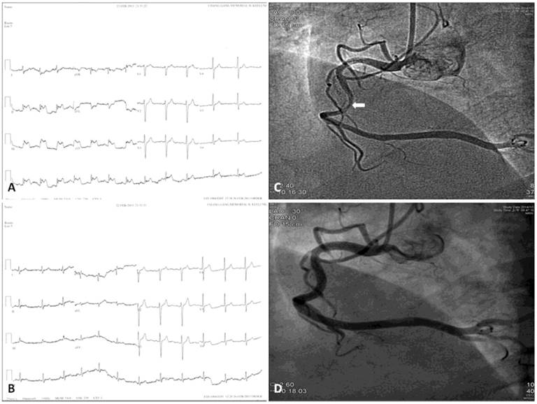 Coronary Artery Spasm: Review and Update