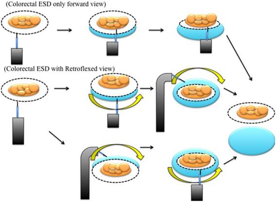 Comparison of Retroflexed and Forward Views for Colorectal Endoscopic ...