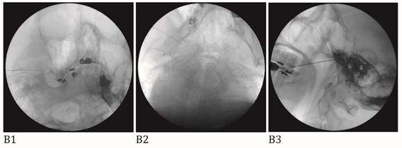 Trigeminal nerve block with alcohol for medically intractable classic ...