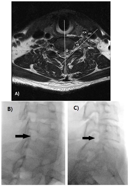 New Optimal Needle Entry Angle for Cervical Transforaminal Epidural ...
