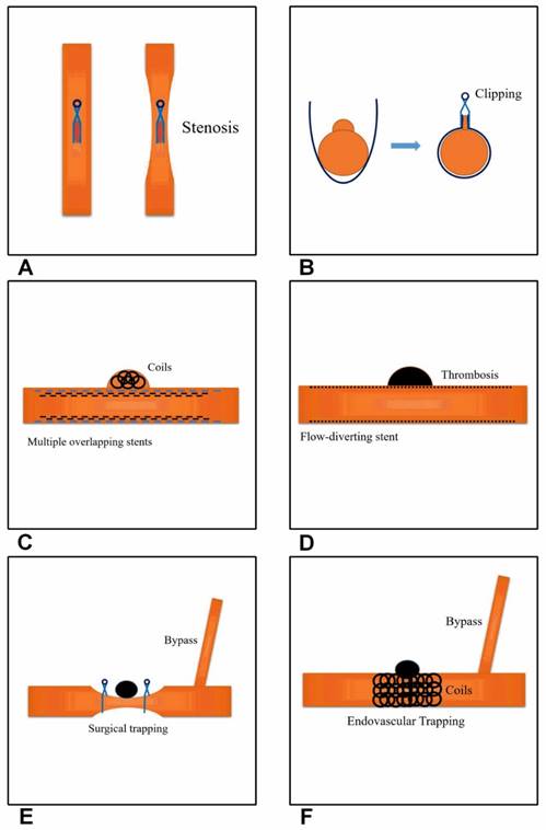 Current status of the treatment of blood blister-like aneurysms of the ...