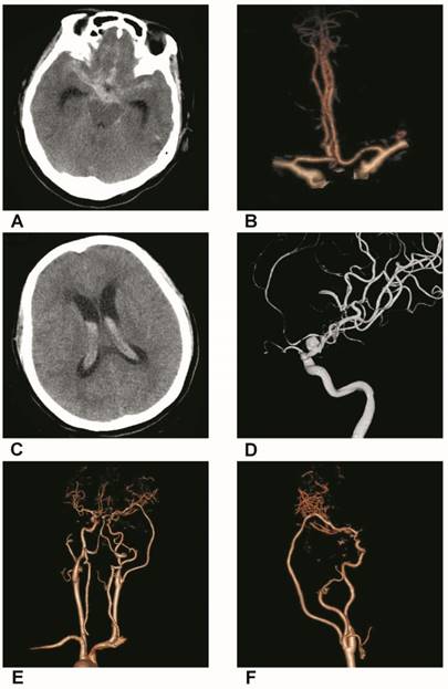 Current status of the treatment of blood blister-like aneurysms of the ...