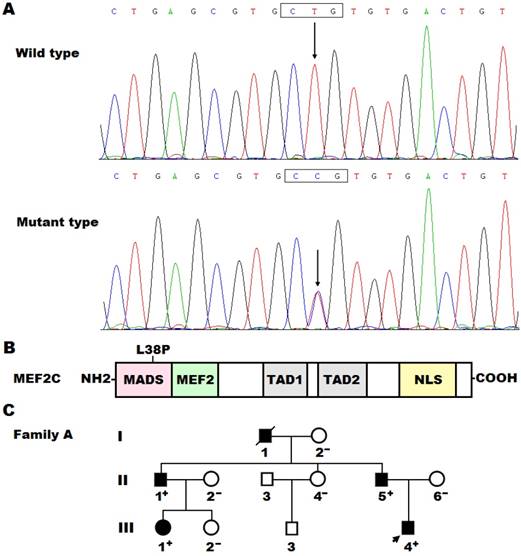 MEF2C loss-of-function mutation contributes to congenital heart defects