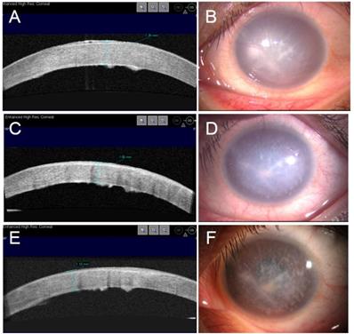 Efficacy of Anterior Stromal Puncture Surgery with Corneal Bandage Lens ...