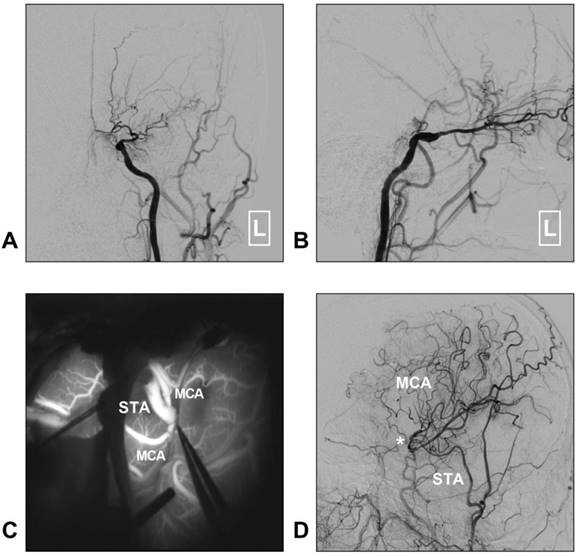 Clinical importance of the superficial temporal artery in neurovascular ...