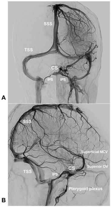 Endovascular treatment of the cavernous sinus dural arteriovenous fistula: current status and ...
