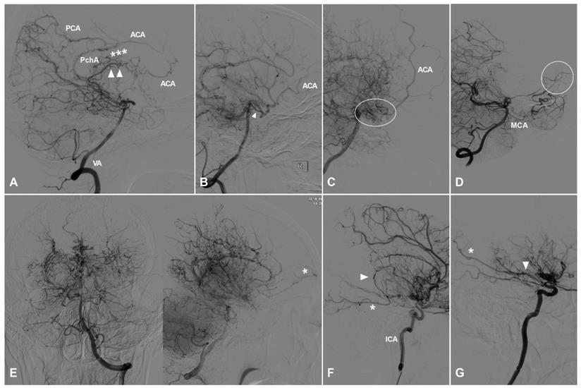 Angiographic study of the transdural collaterals at the anterior ...