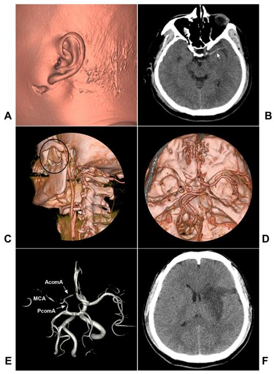 Endovascular treatment of blunt injury of the extracranial internal ...
