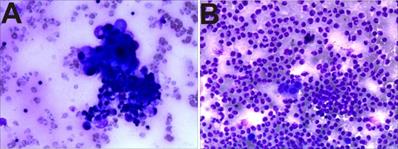 Development and validation a simple model for identify malignant ascites