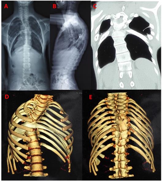 Intrathoracic rib: rare rib anomaly, review of the literature and ...