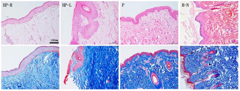 In situ scarless skin healing of a severe human burn wound induced by a ...