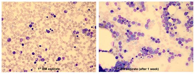 Natural Killer Cell Activity Test Helps to Suspect Aggressive Natural ...