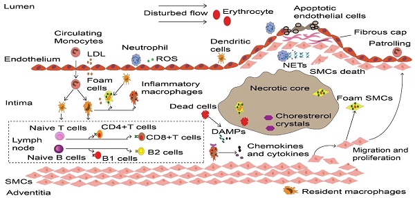 Foam Cell Atherosclerosis